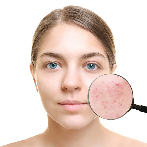 Vitamini za lečenje akni - Dermatolog | Dermatologija | Ordinacija ...