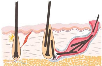 Pilonidalni sinus (dermoidne ciste) - Dermatolog | Dermatologija ...